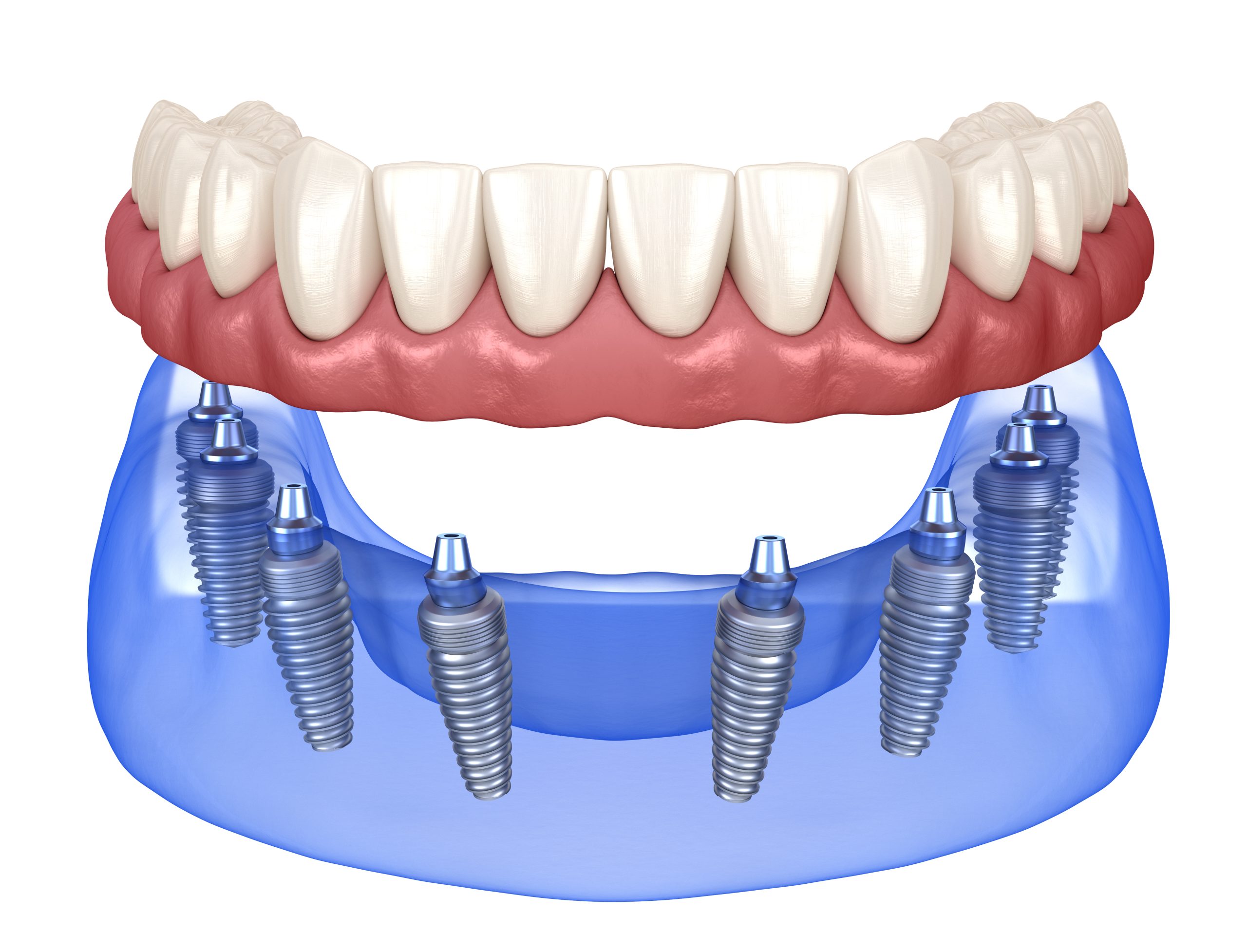All-on-8 Dental Implants in Mexico | MexicoDent
