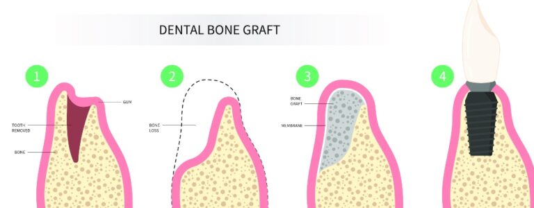 Dental Bone Graft Cost in Mexico and Types at Mexicodent