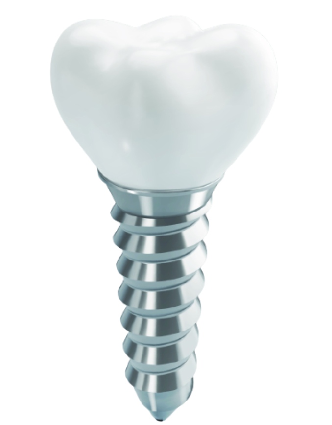 Mini Dental Implants Cancun, Mexico - Mexicodent