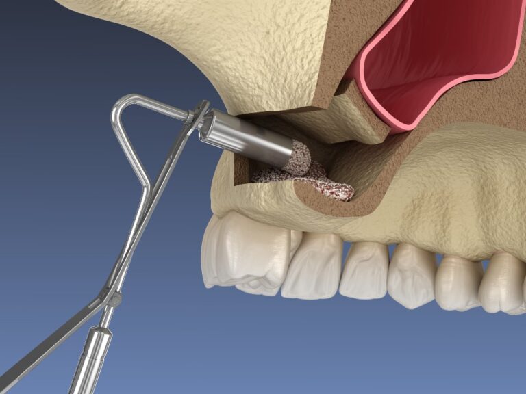 Dental Bone Graft Cost in Mexico and Types at Mexicodent