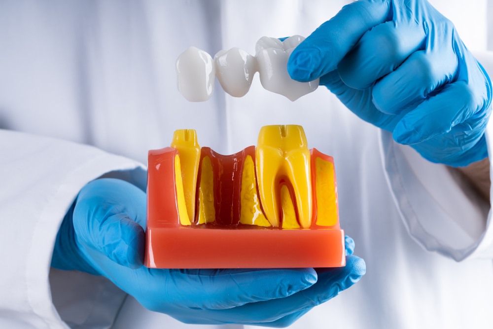 3 Unit Dental Bridge Cost in Mexico | Mexicodent