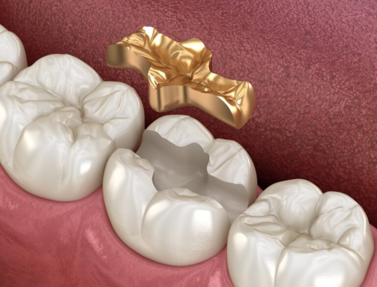 Gold Teeth in Mexico – Implants and Crowns at Mexicodent